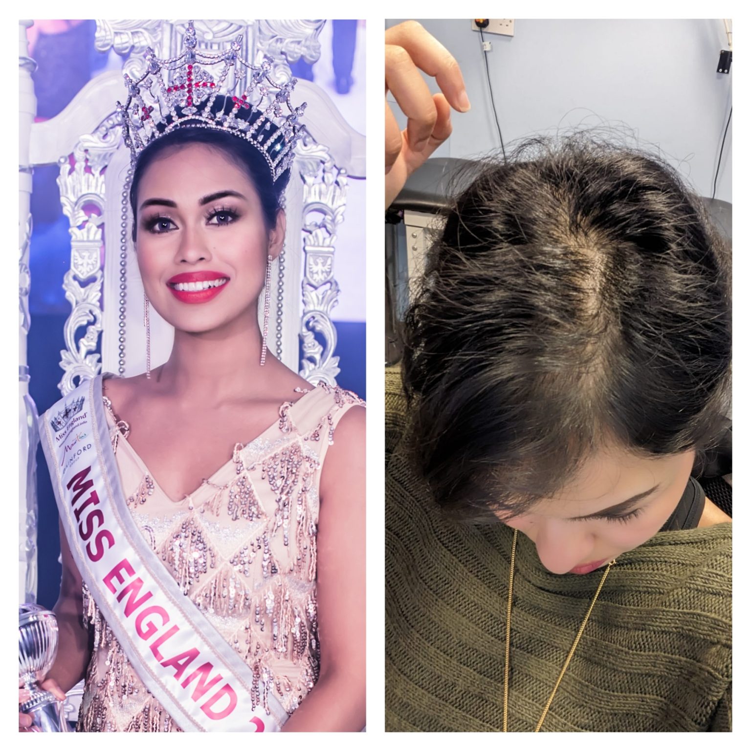 Former Miss England talks about Hair Loss as Watermans becomes Headline ...